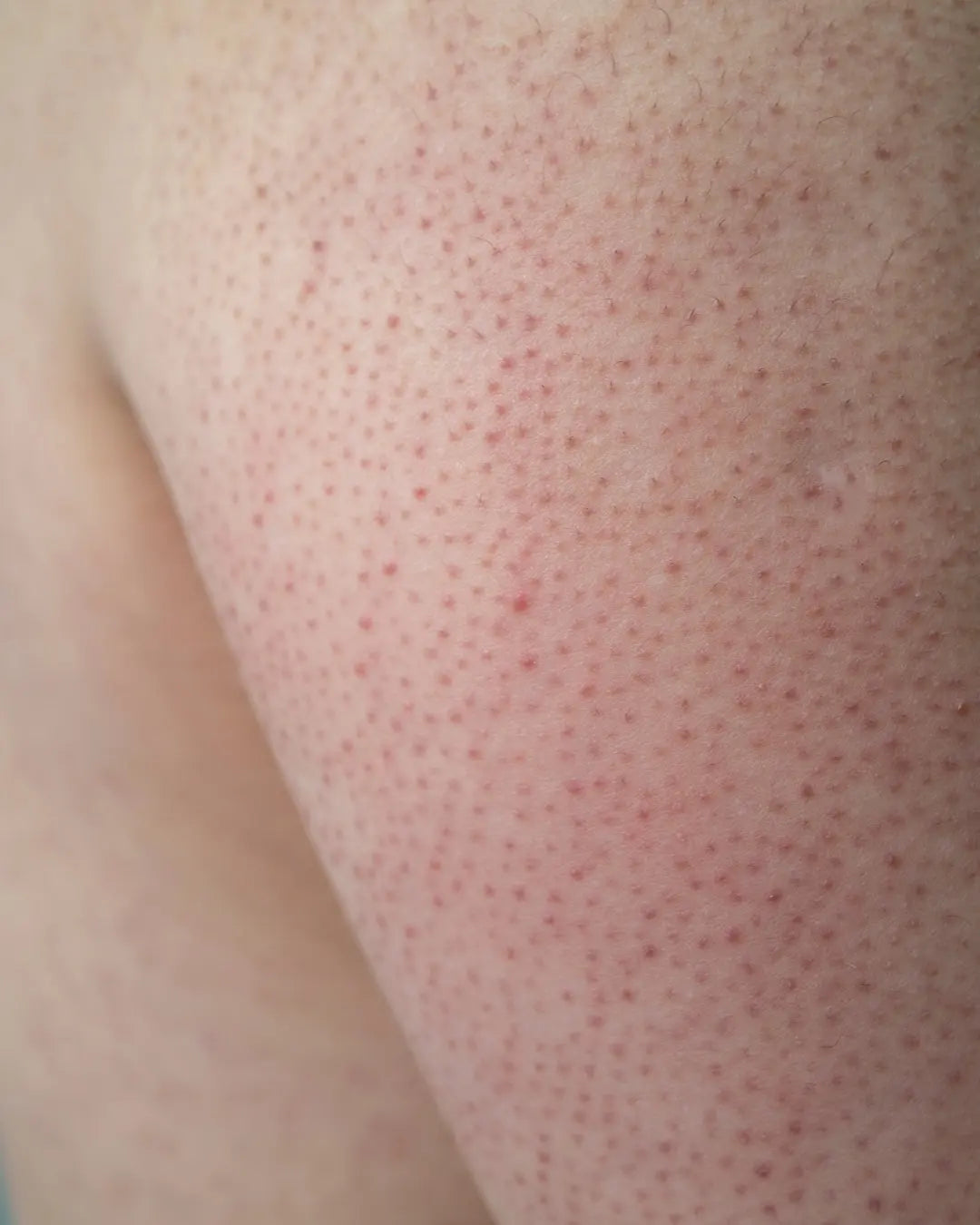 Effective ways to get rid of Keratosis Pilaris. Say Goodbye to Bumpy – PALS