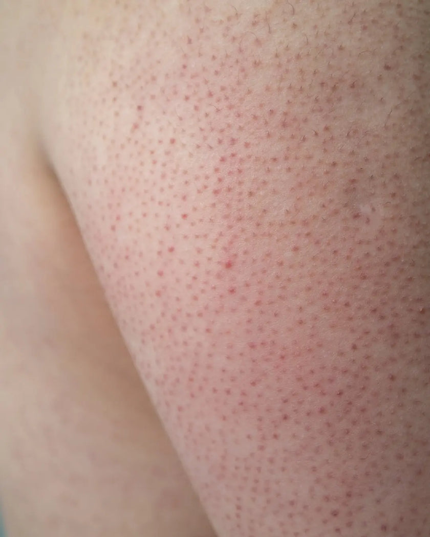 Effective ways to get rid of Keratosis Pilaris. Say Goodbye to Bumpy – PALS